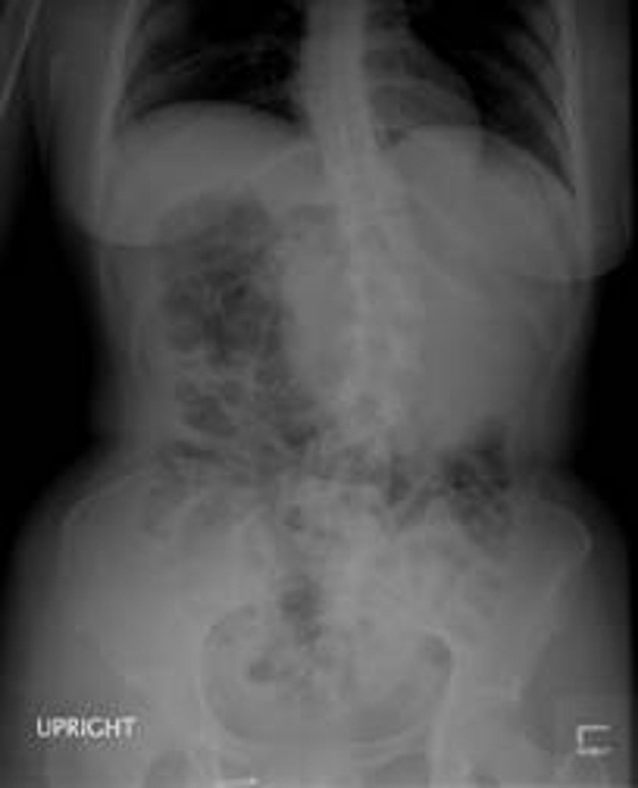 Case Report: Trichobezoar in a 25 year old Autistic Female – The New ...