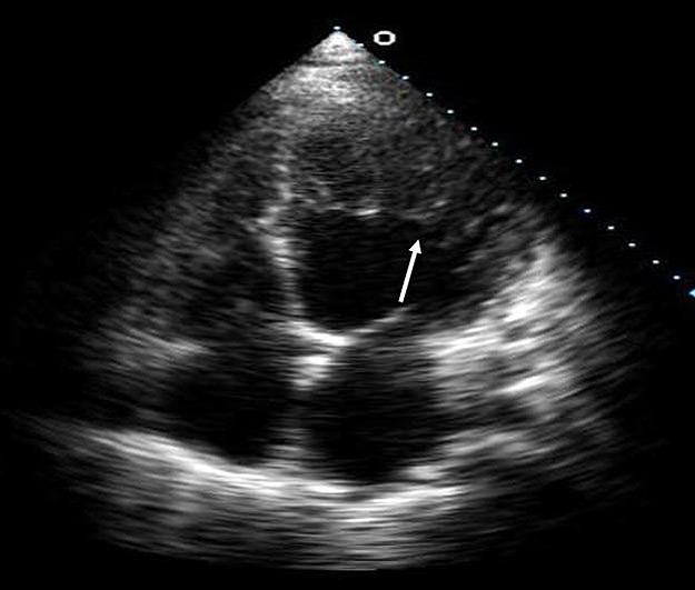“Spongy Myocardium”: Left ventricular non compaction – The New York ...