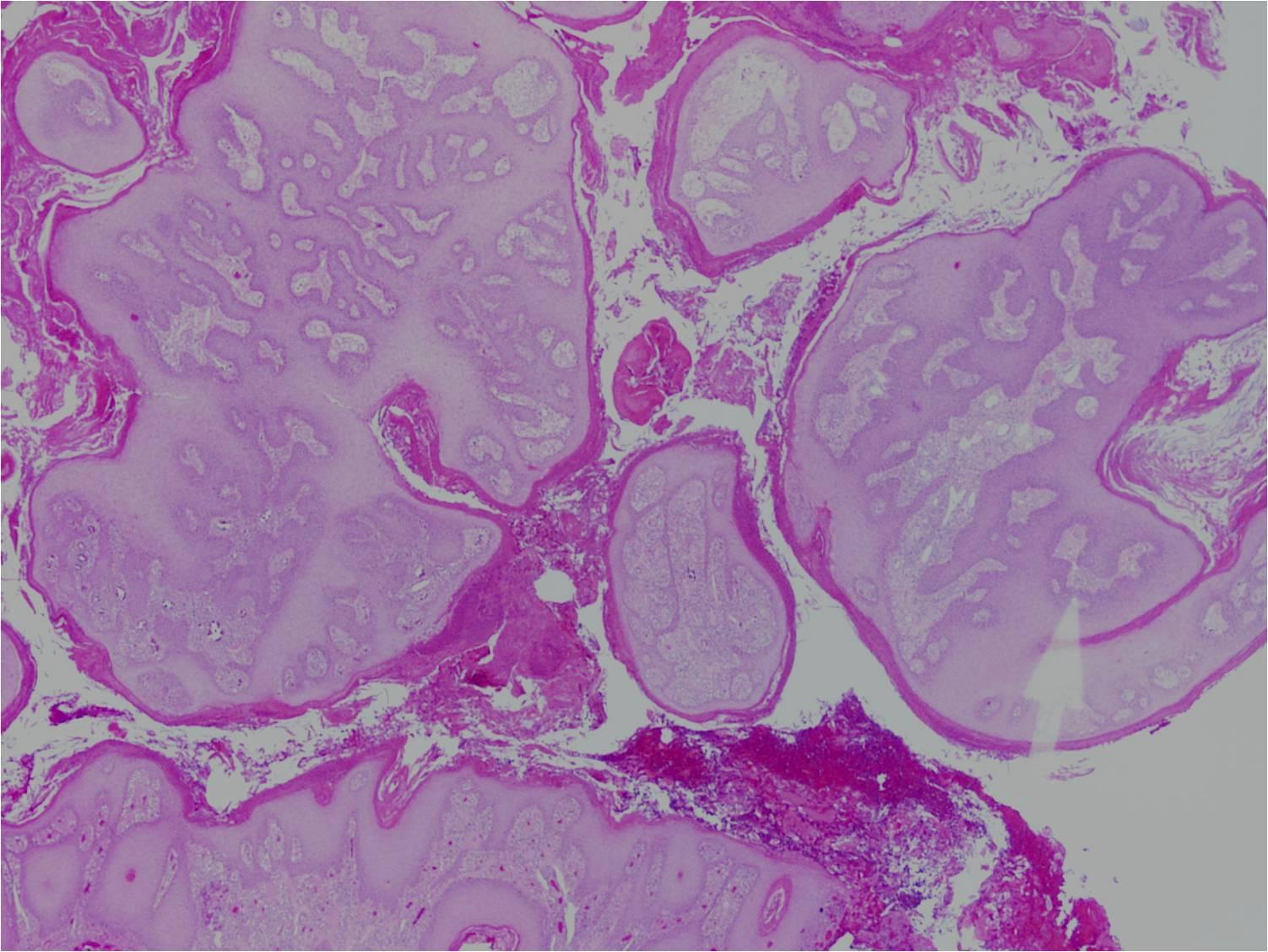 Condyloma acuminatum – The New York Medical Journal