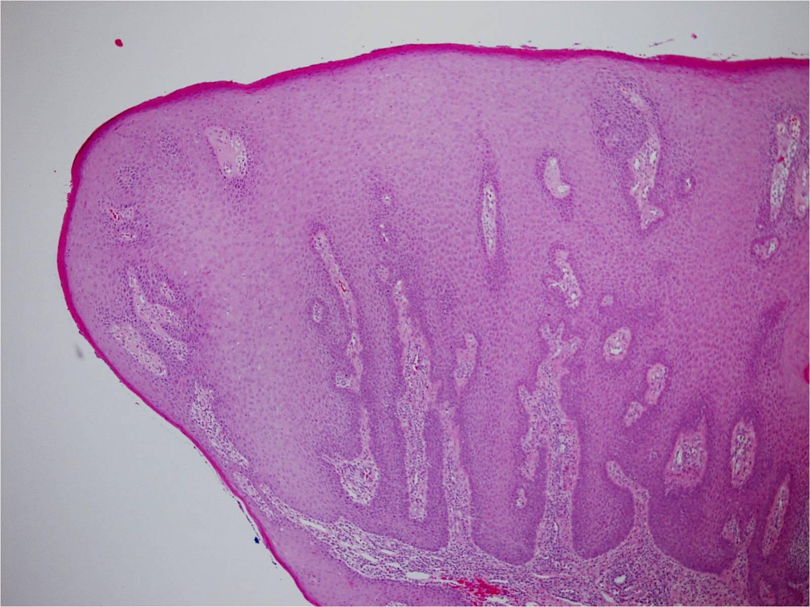 Condyloma acuminatum – The New York Medical Journal