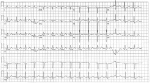 EKG Case of the Month – U Waves – The New York Medical Journal